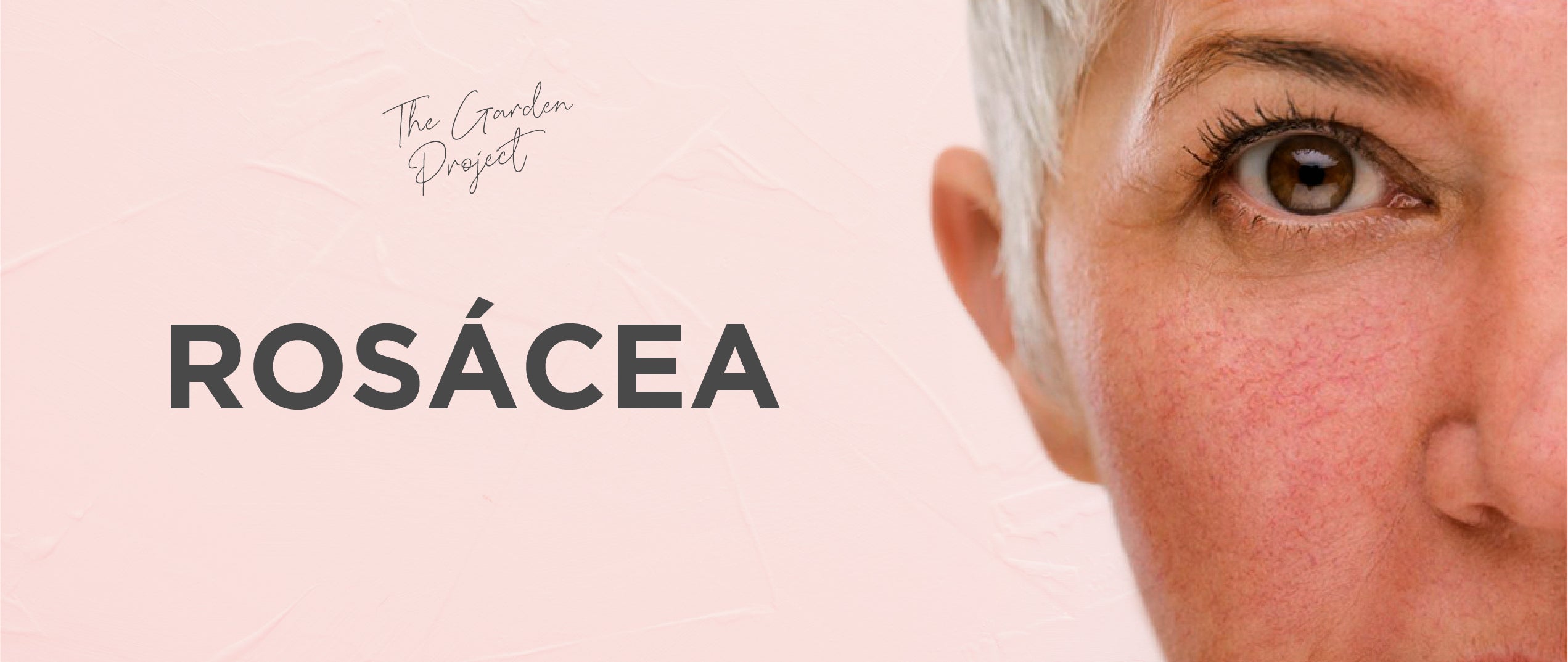 Más allá de la piel roja: Descubre todo sobre la Rosácea – The Garden ...